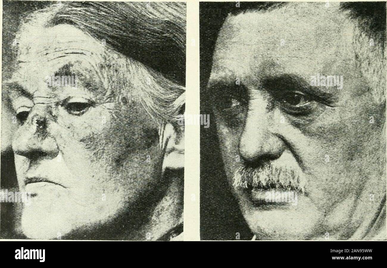 Rodent ulcer hi-res stock photography and images - Alamy