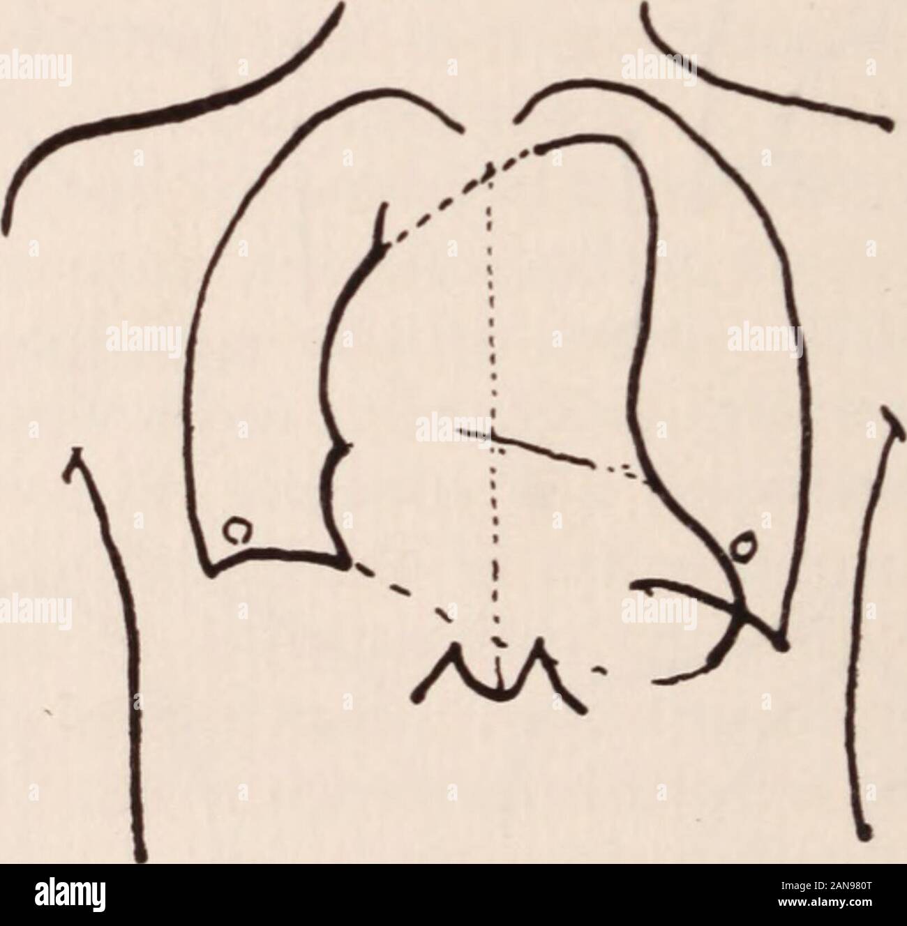 Albany medical annals . Aortic Regurgitation; Dilatation Mitral ...