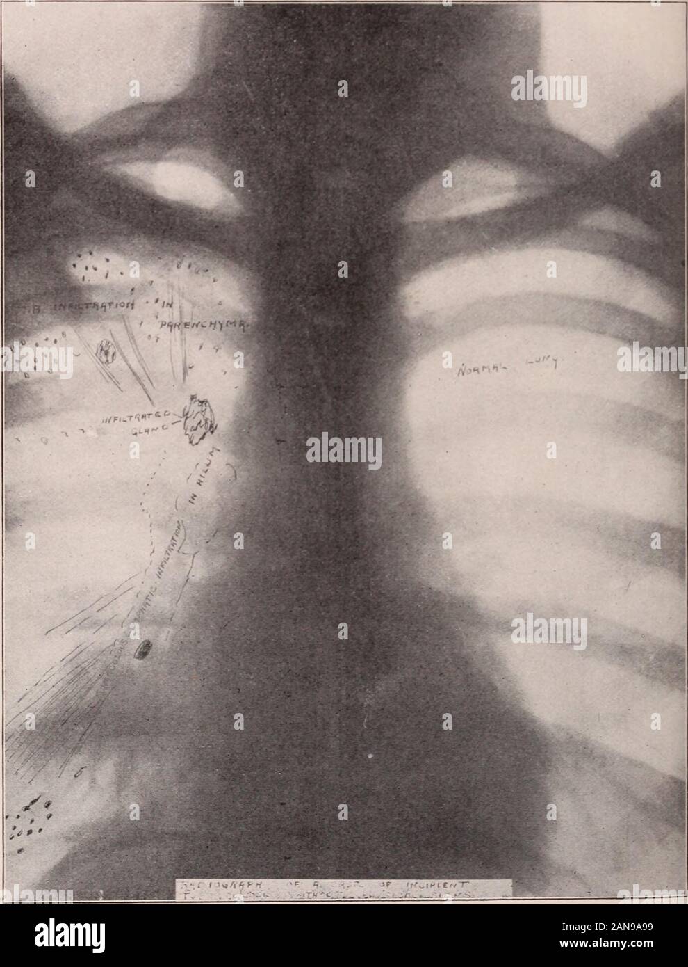 Roentgen radiogram hi-res stock photography and images - Alamy