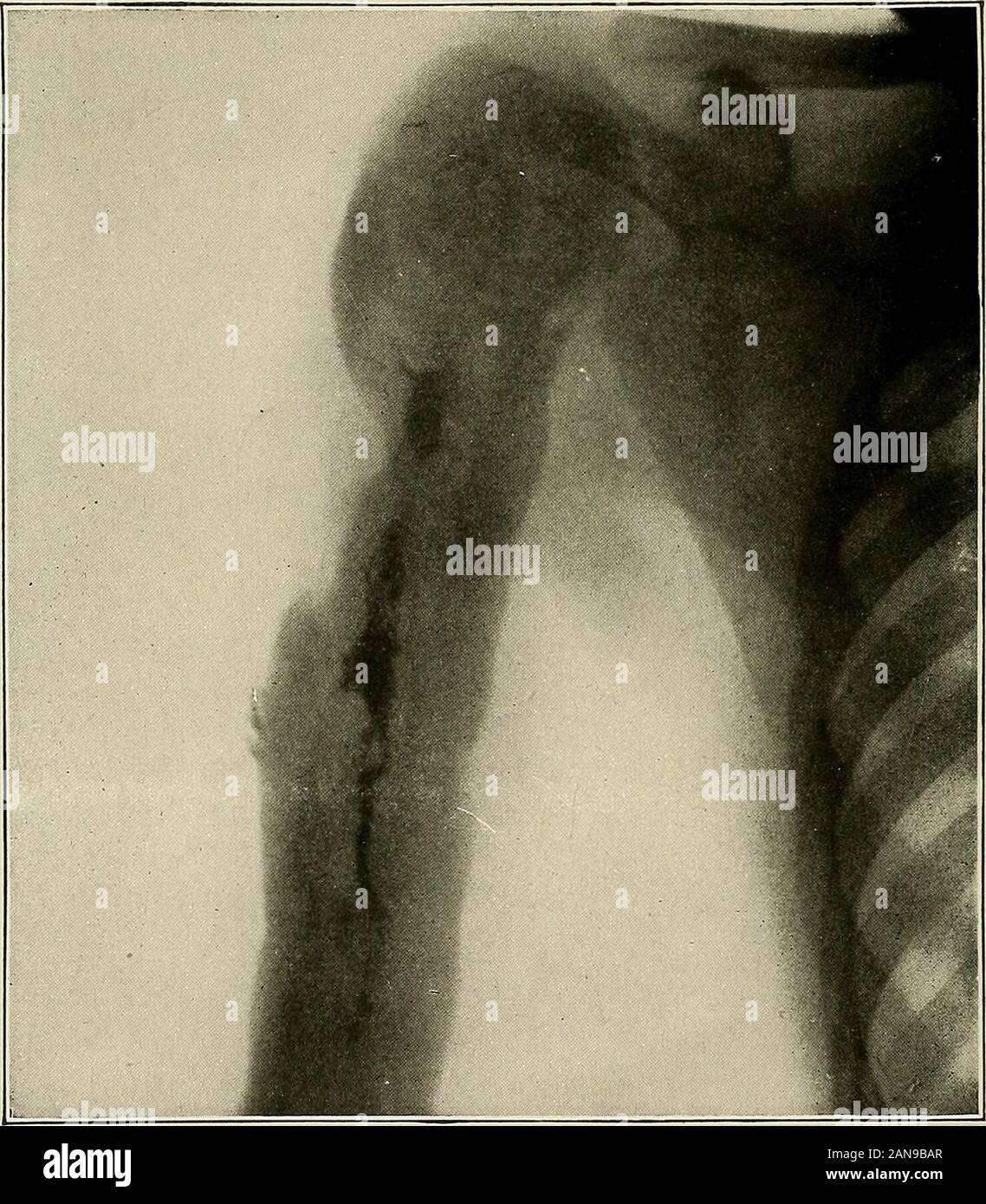 Bismuth paste in chronic suppurations, its diagnostic importance and ...
