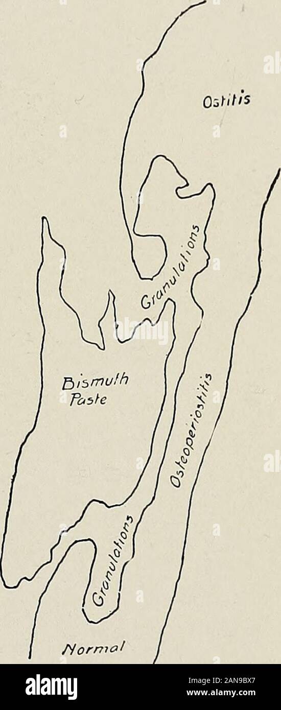 Bismuth paste in chronic suppurations, its diagnostic importance and ...