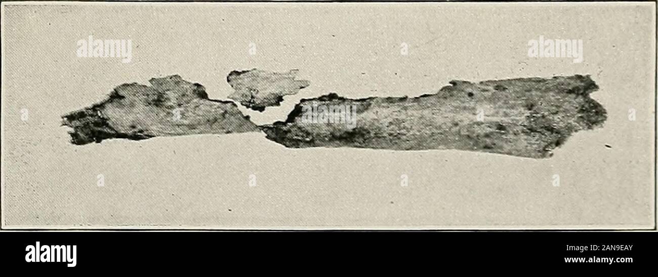 Bismuth paste in chronic suppurations, its diagnostic importance and ...