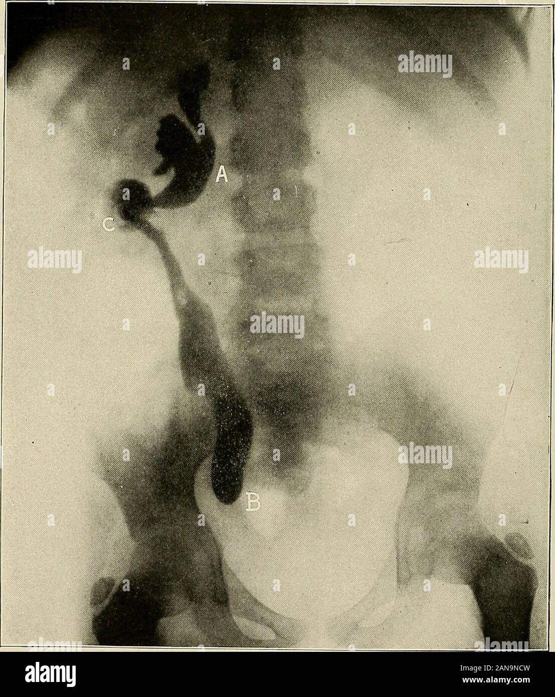 Subphrenic abscess hi-res stock photography and images - Alamy