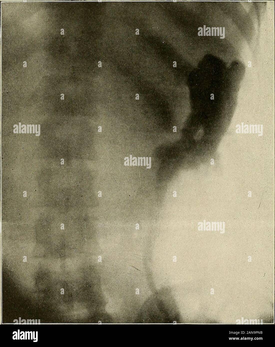 Bismuth paste in chronic suppurations, its diagnostic importance and ...