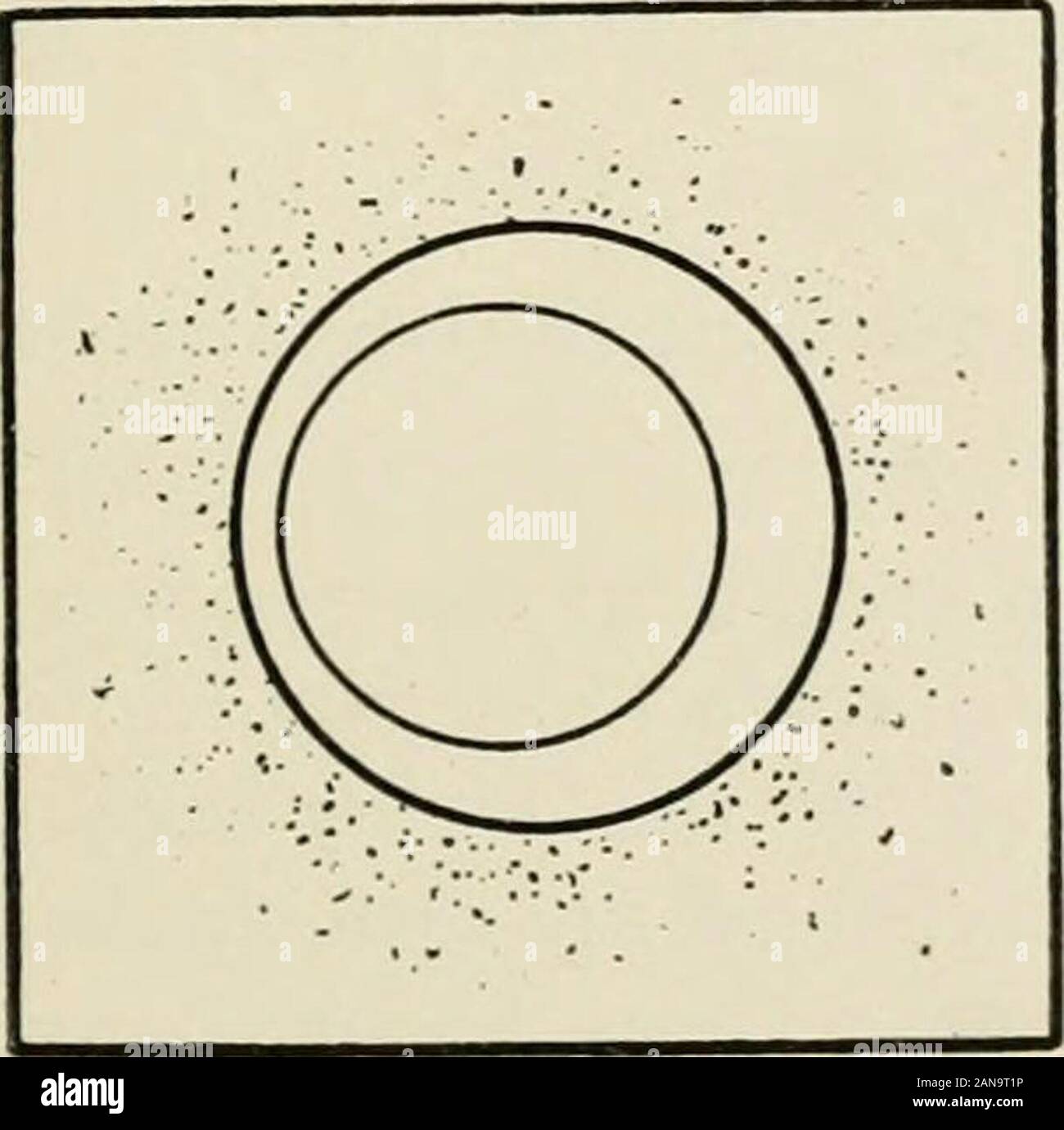 Squint : its causes, pathology and treatment . Fig. 17 Stock Photo - Alamy