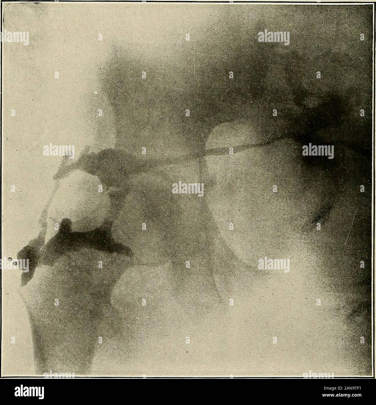 Bismuth paste in chronic suppurations, its diagnostic importance and ...
