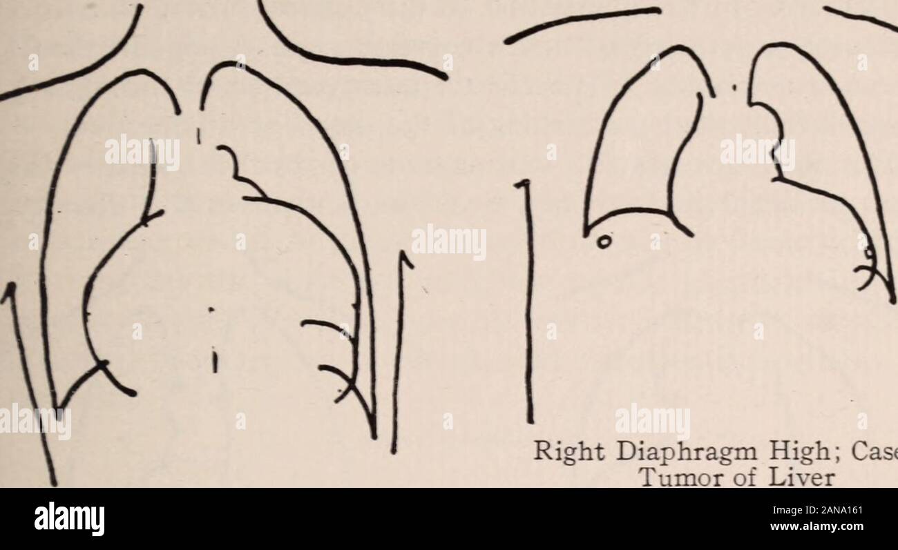 Mitralregurgitation hi-res stock photography and images - Alamy