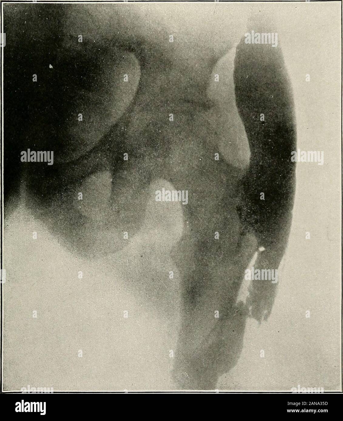 Bismuth paste in chronic suppurations, its diagnostic importance and ...