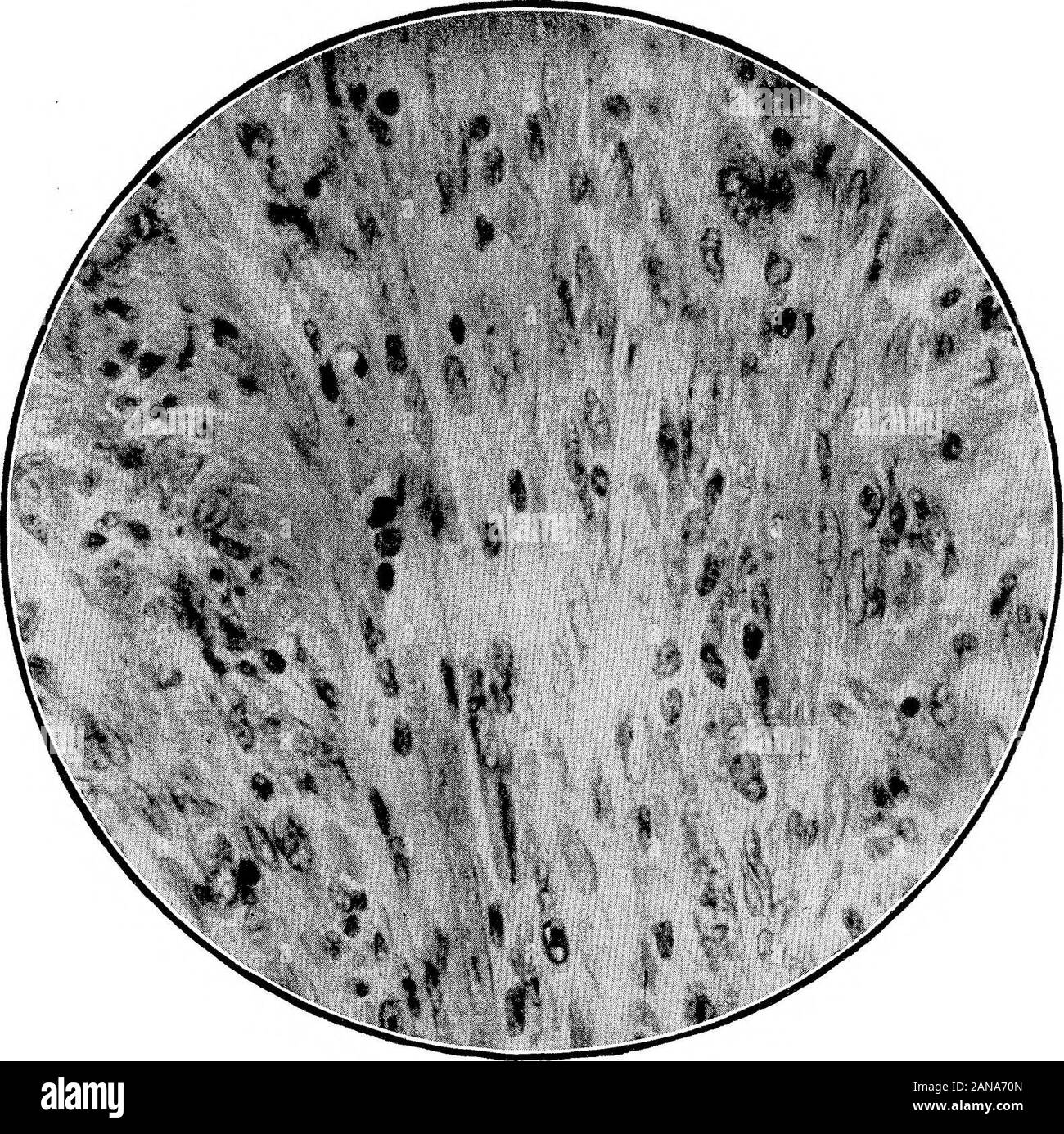 Sarcoma cells Black and White Stock Photos & Images - Alamy