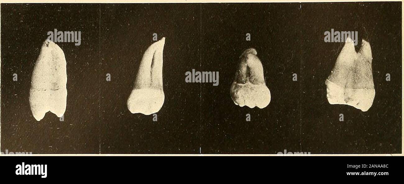 Bicuspids hi-res stock photography and images - Alamy