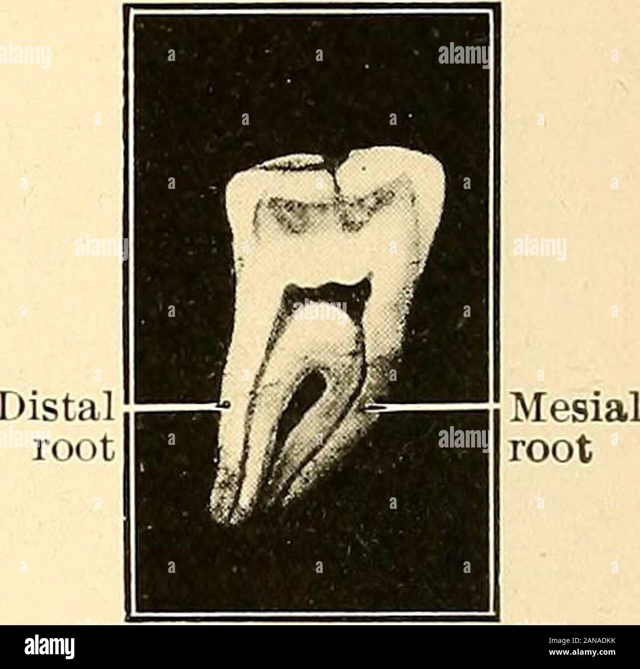 Principles and practice of operative dentistry . Distalroot Q ...