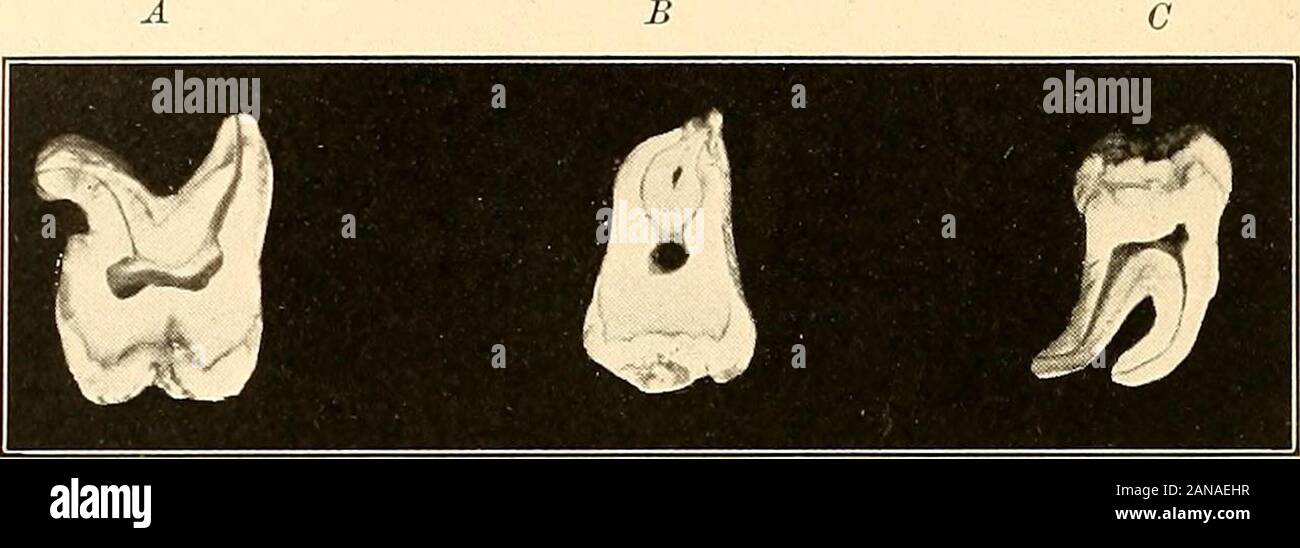 Third molar hi-res stock photography and images - Alamy