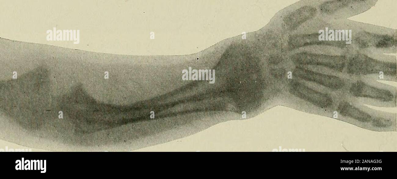 Osteomalazie hi-res stock photography and images - Alamy
