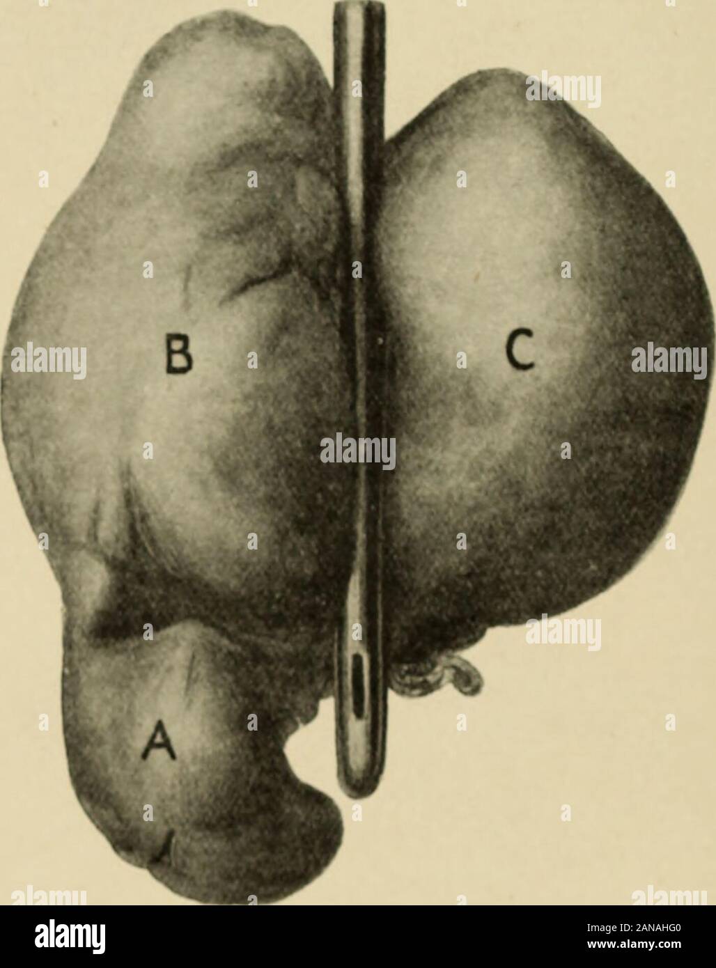 Catheterism hi-res stock photography and images - Alamy