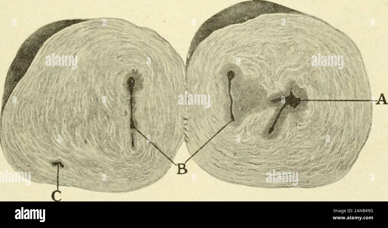 Fibroids and allied tumours (myoma and adenomyoma) : their pathology ...