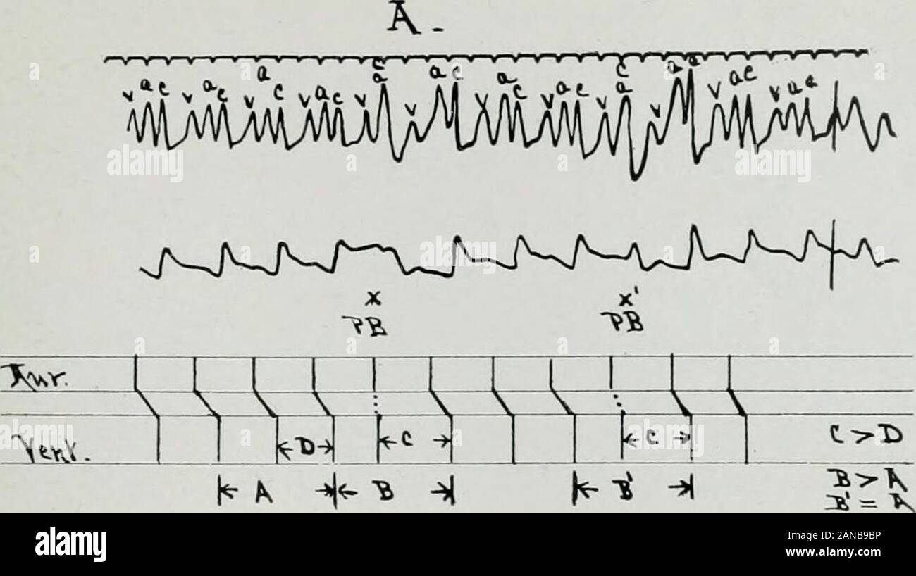 Premature ventricular beats hi-res stock photography and images - Alamy