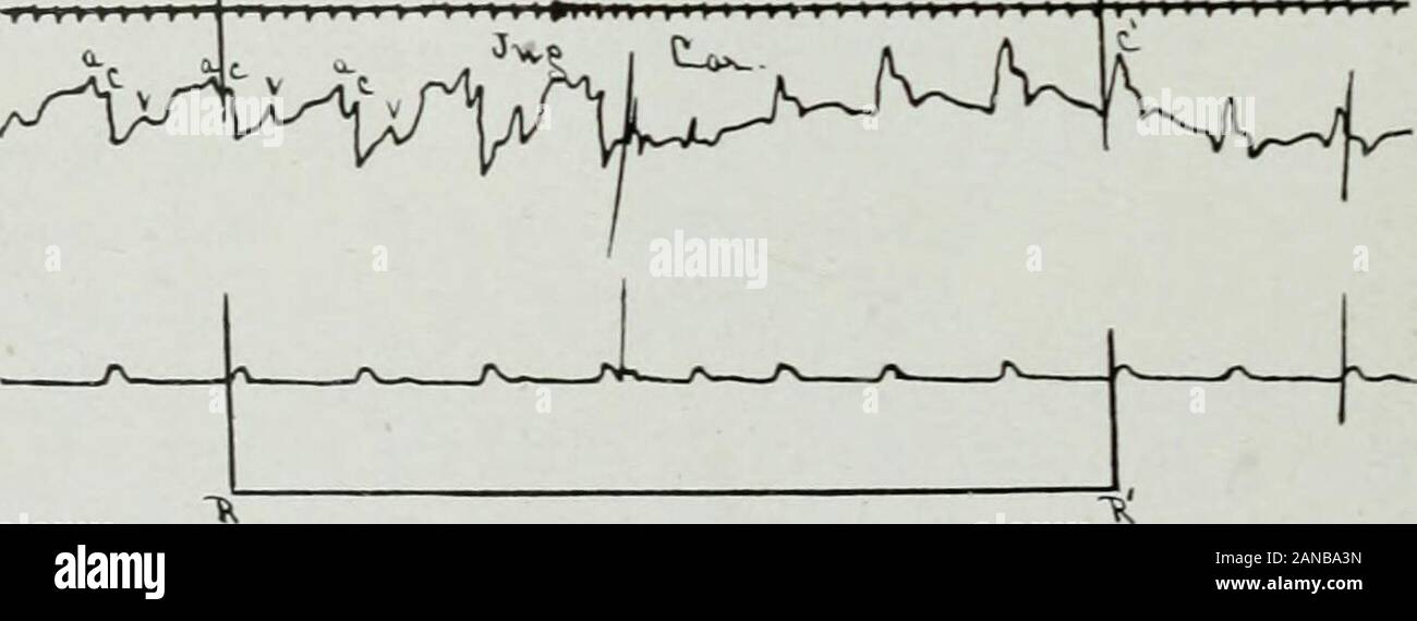 Carotid Pulse Tracing