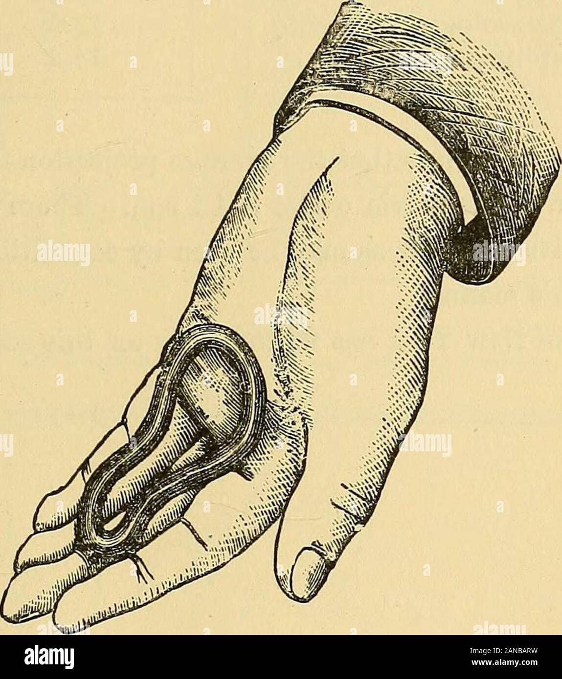 Manual of gynecology . (Fig. 56) ; 3. Below it in prolapsus uteri; 4 ...