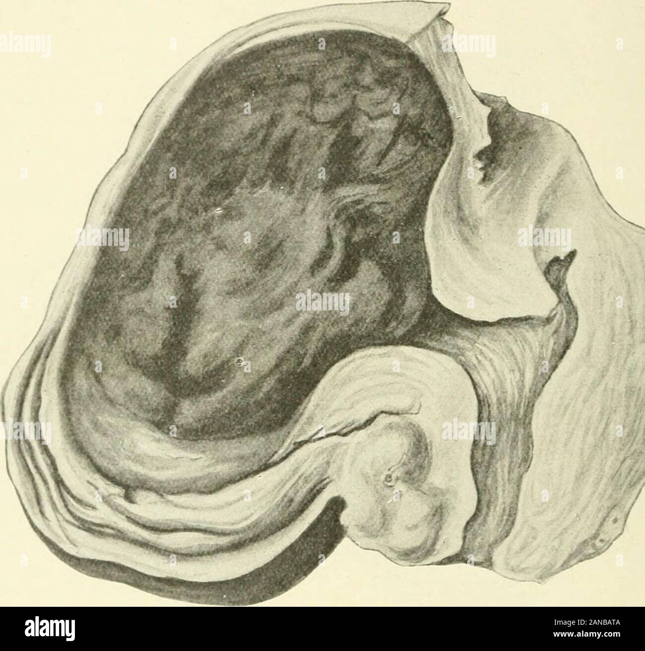 Fibroids and allied tumours (myoma and adenomyoma) : their pathology ...