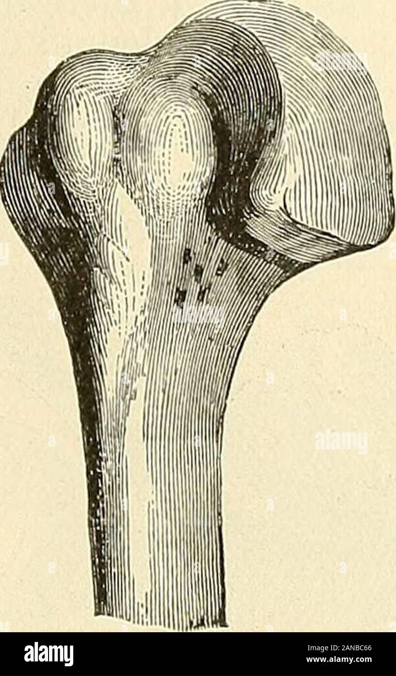Dislocation of shoulders hi-res stock photography and images - Alamy
