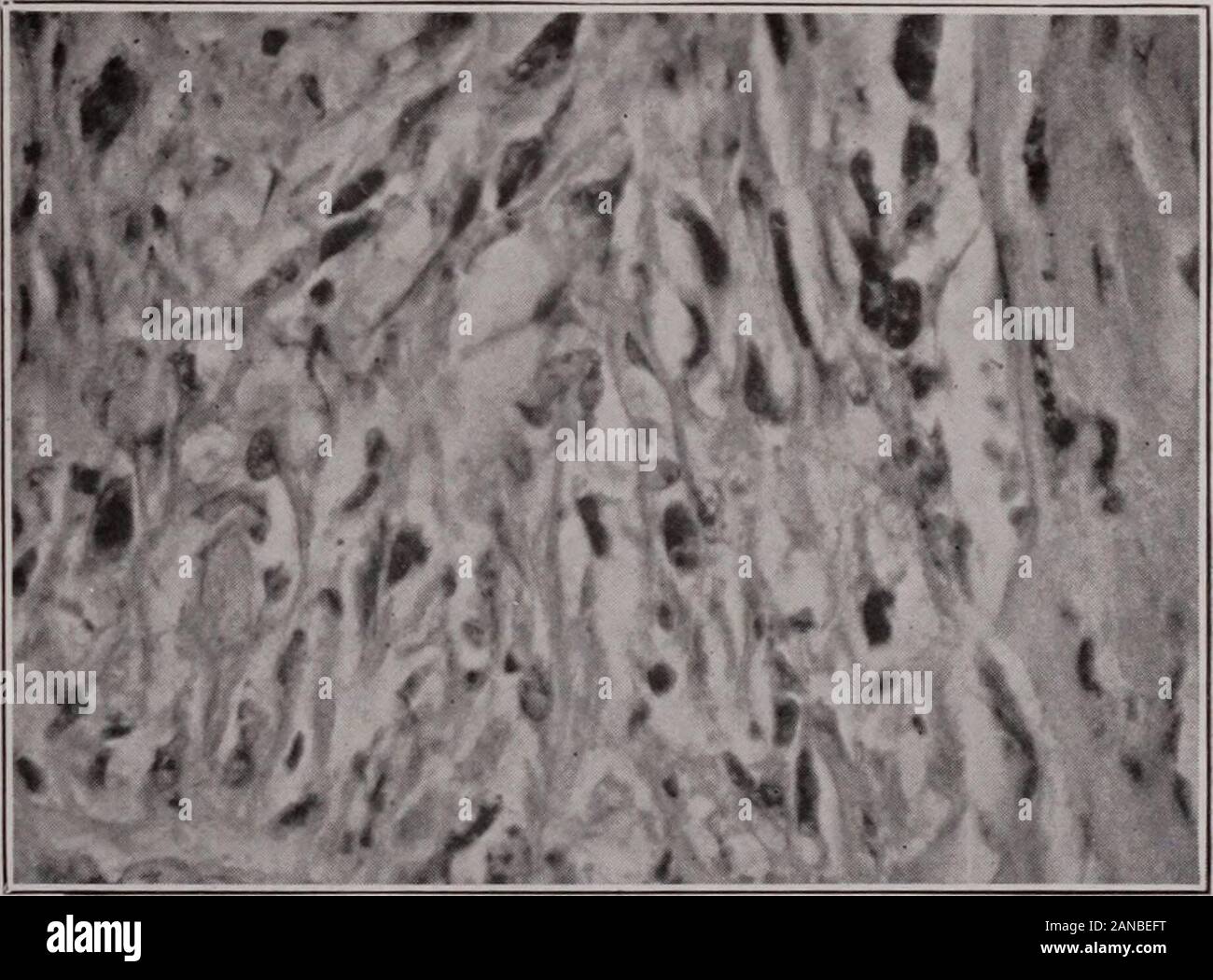 Anaplasia hi-res stock photography and images - Alamy