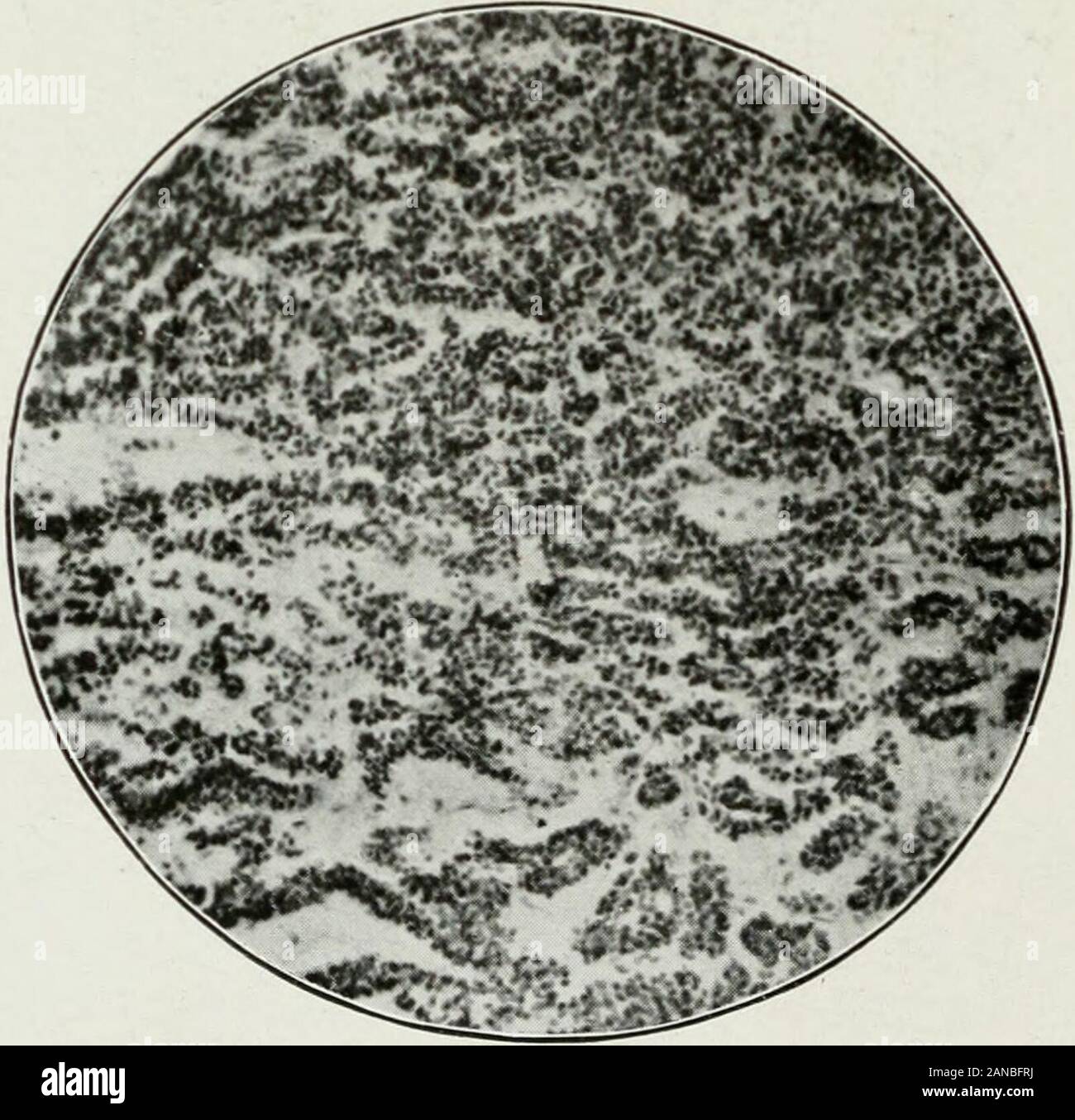 Archives of internal medicine . Fig. 17.—Fetal adenonia un(Ur