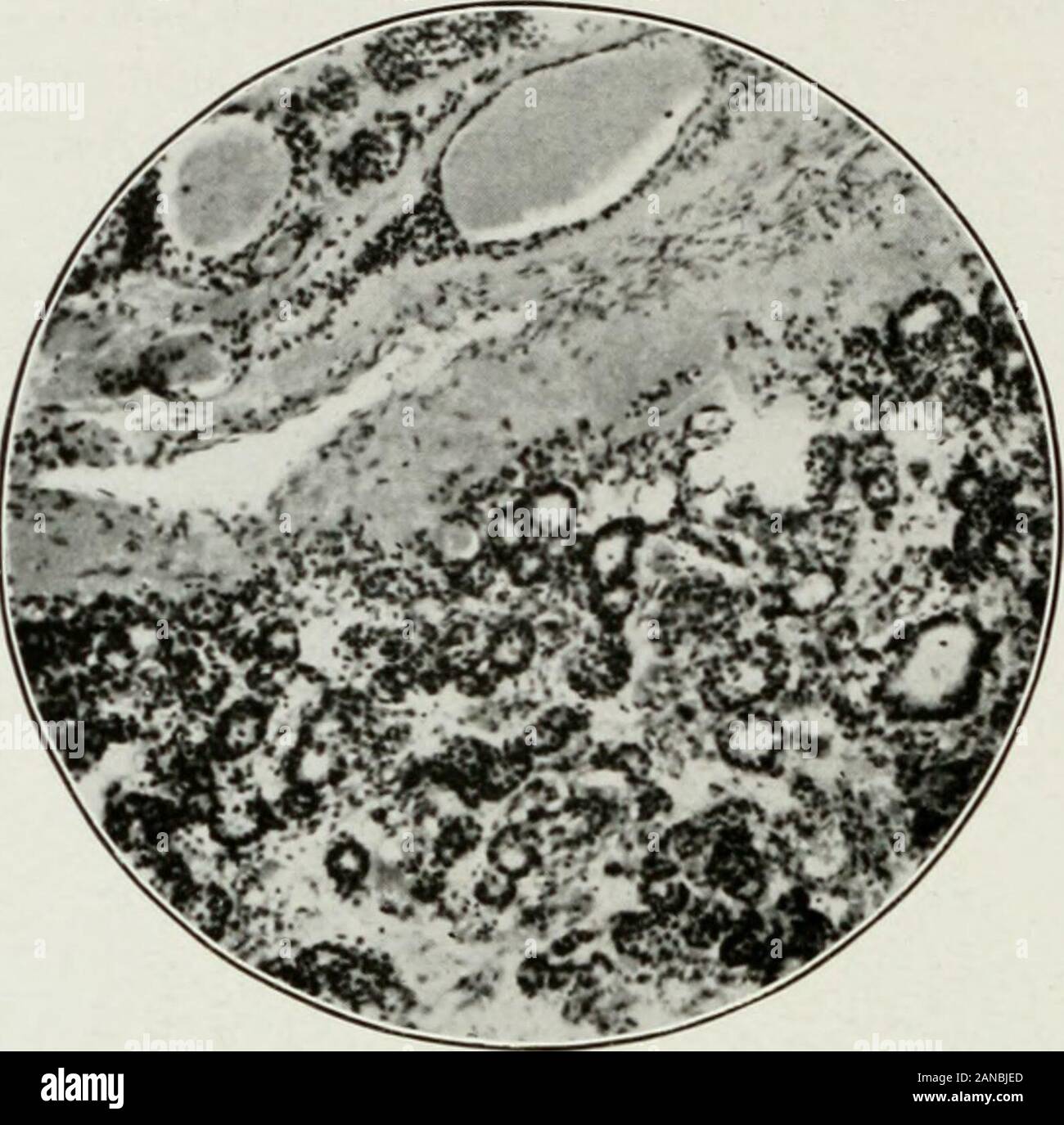 Archives of internal medicine . Fig. 13.—Adenoma representing ...