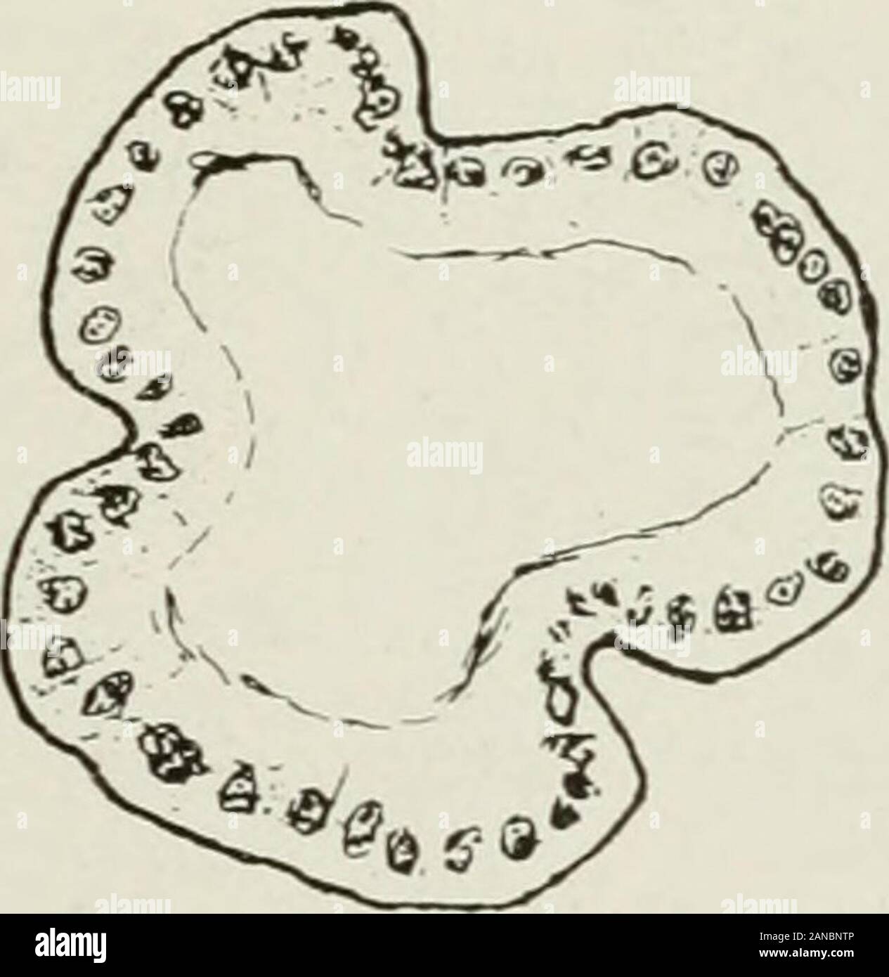 Colloid in thyroid hi-res stock photography and images - Alamy