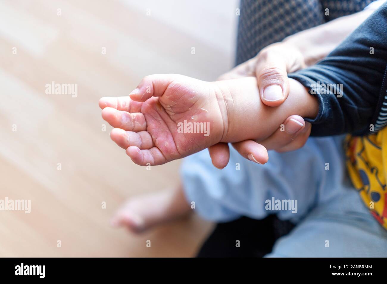 Burn hand of baby hi-res stock photography and images - Alamy