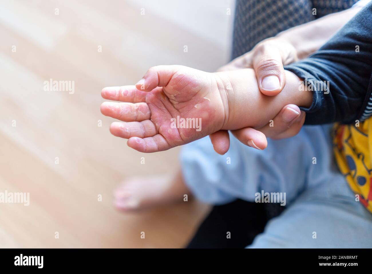 Infant burn hi-res stock photography and images - Alamy