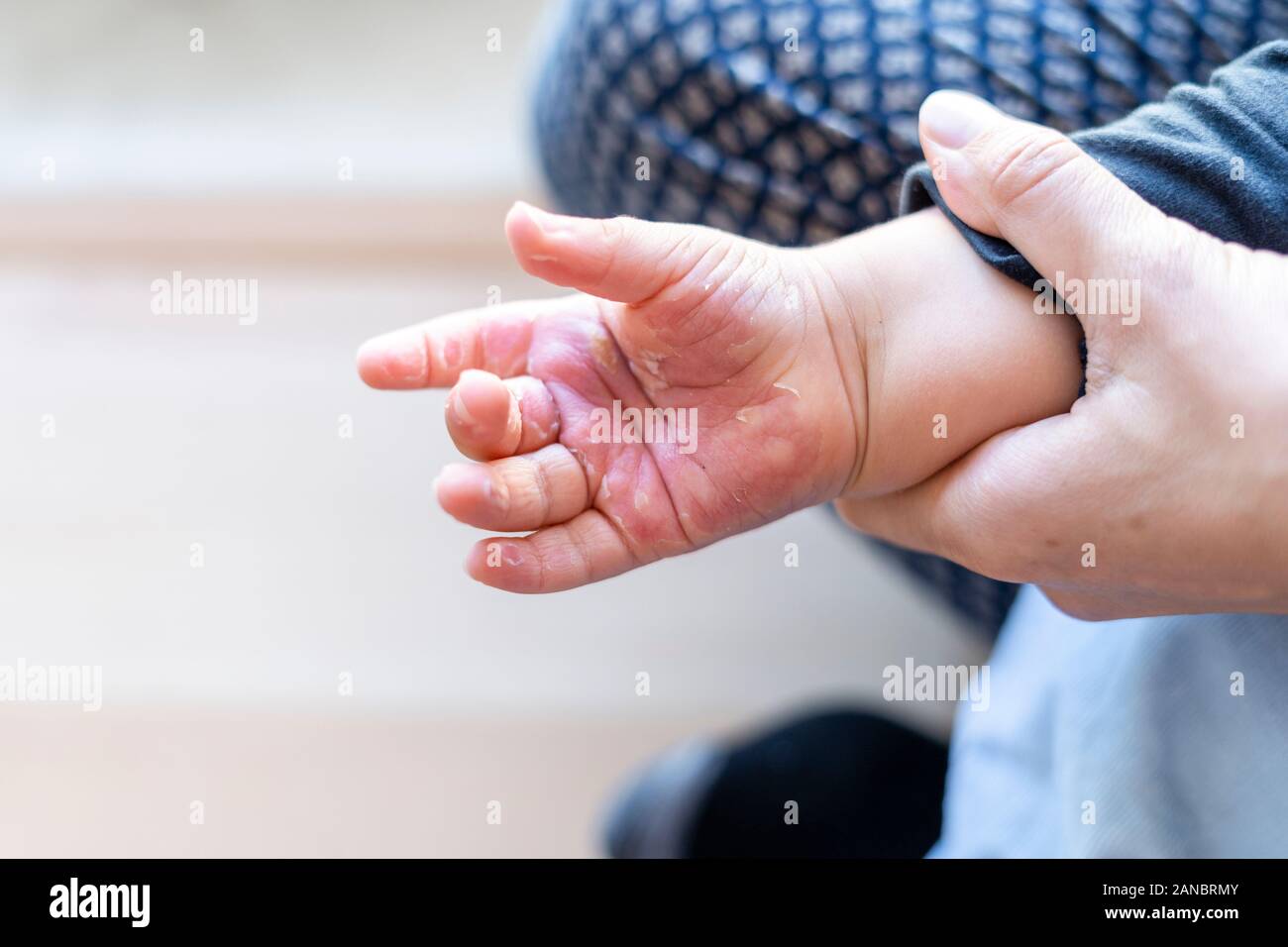 Burned skin child hi-res stock photography and images - Alamy