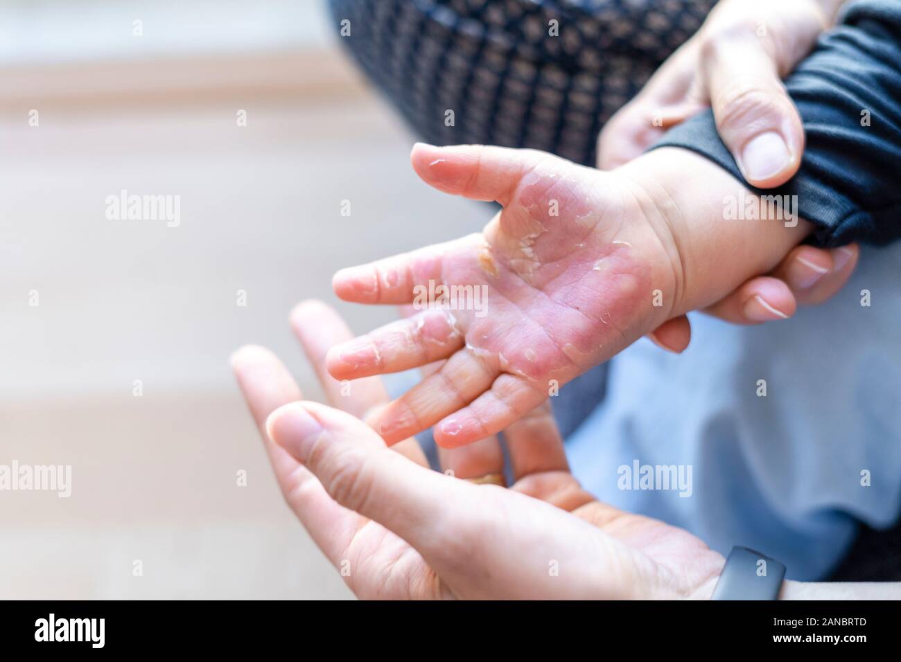 Burned skin kid hi-res stock photography and images - Alamy