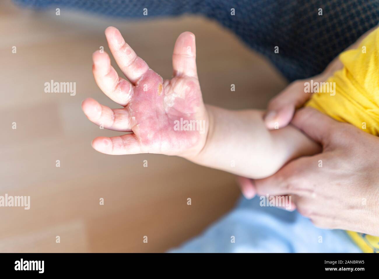 Burned skin child hi-res stock photography and images - Alamy