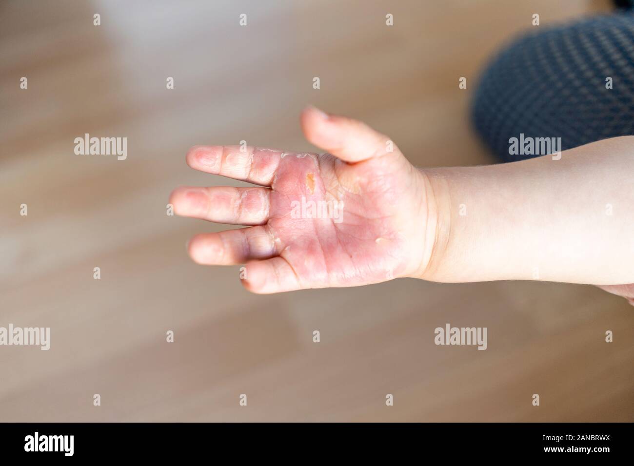 Burned fingers hi-res stock photography and images - Alamy