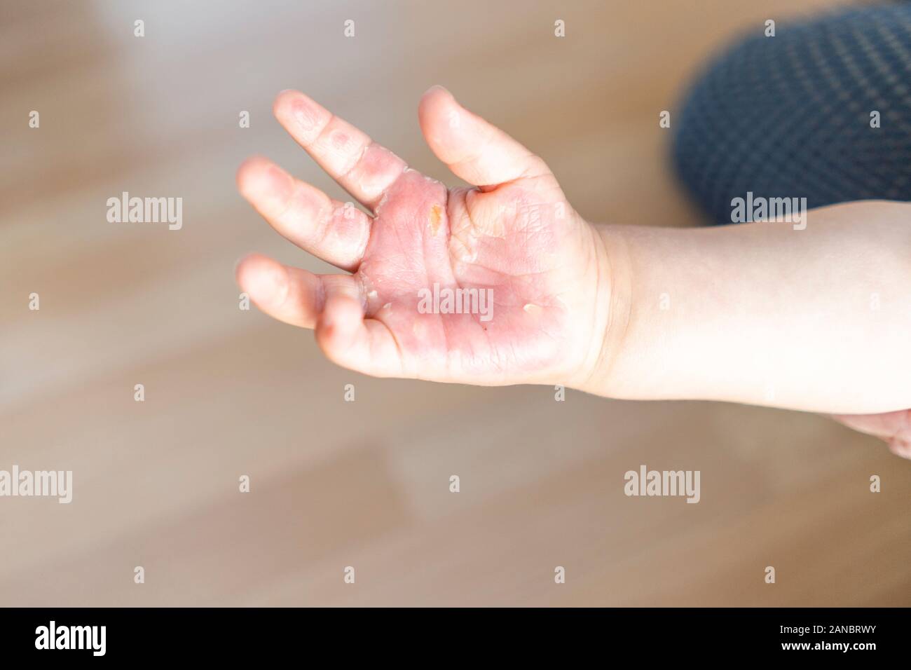 Burned skin kid hi-res stock photography and images - Alamy
