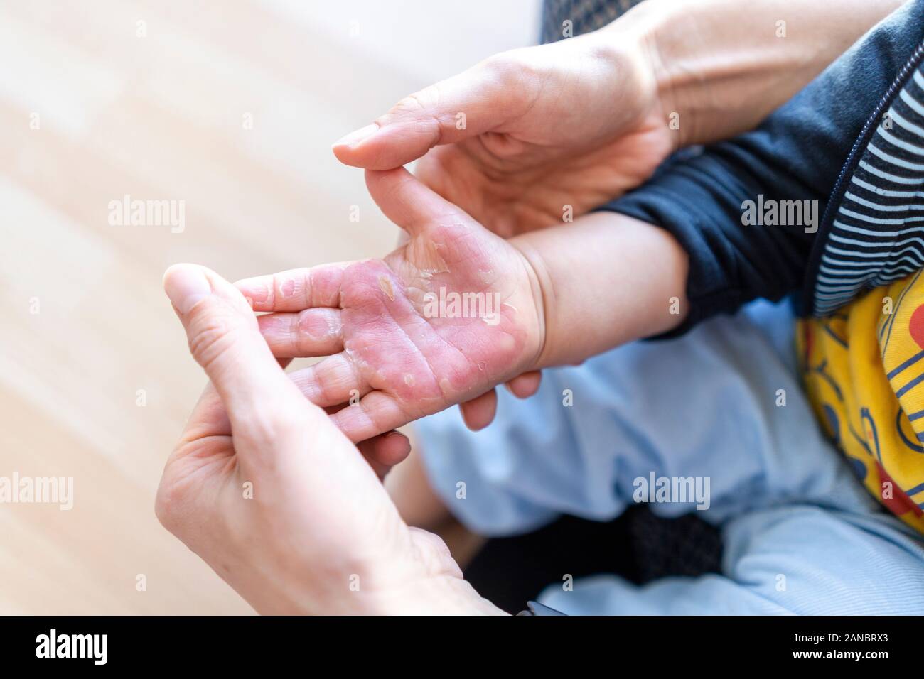 Burned skin kid hi-res stock photography and images - Alamy