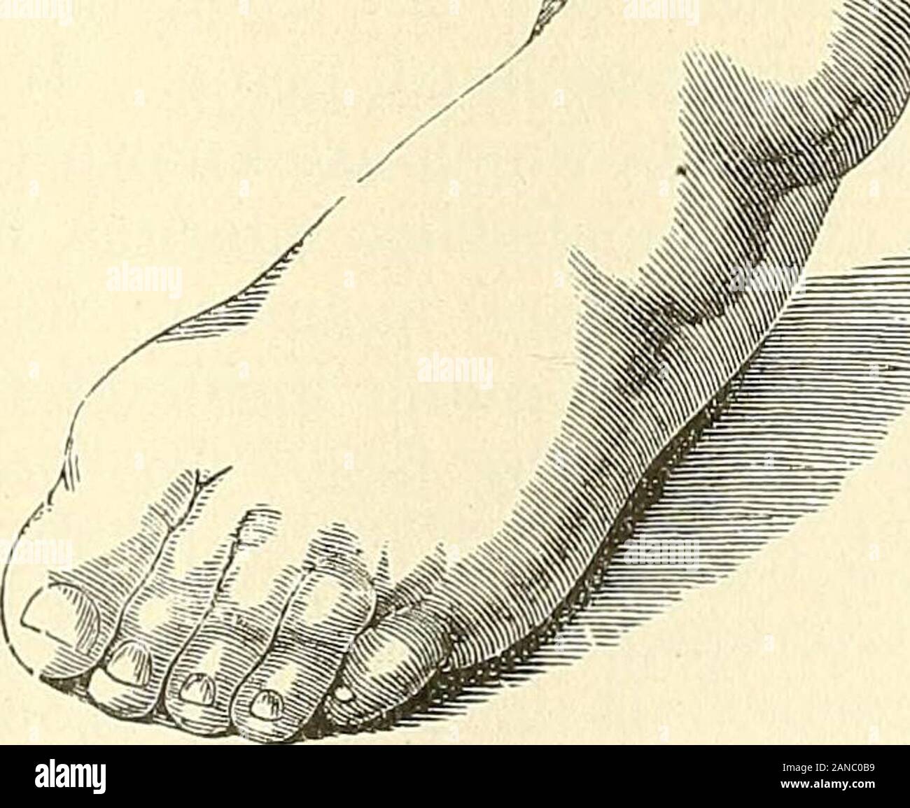 A practical treatise on fractures and dislocations . Dislocation of the ...