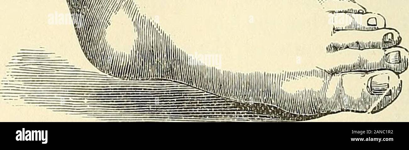 Inward foot hi-res stock photography and images - Alamy