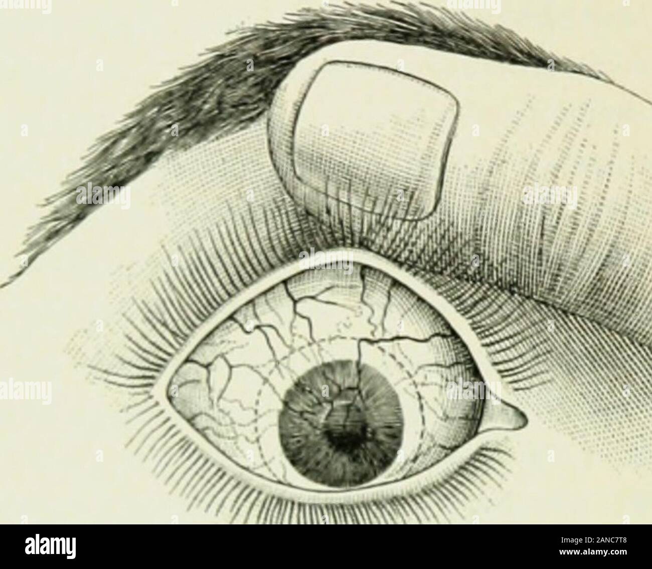 Blennorrhea hi-res stock photography and images - Alamy