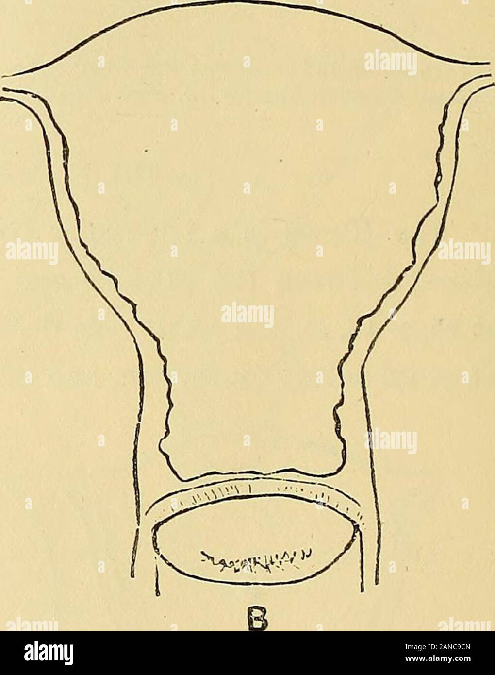 Manual of gynecology . Fig. 14.A. Muciparous uterus In coronal section ...