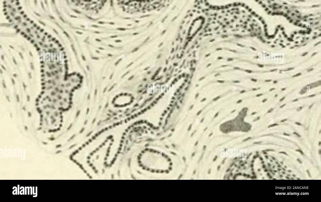 Salpingitis isthmica nodosa hi-res stock photography and images - Alamy