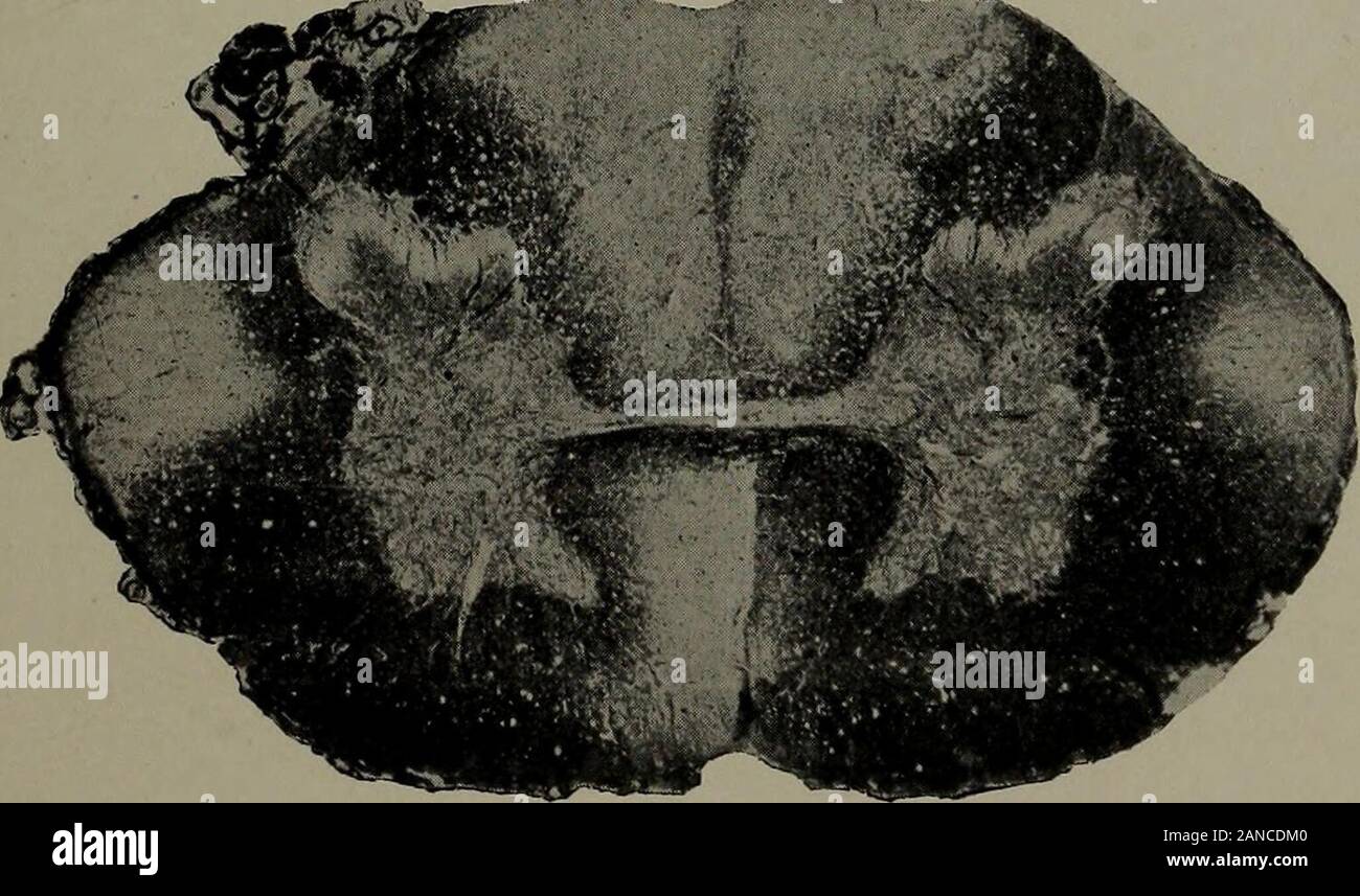 Lumbar roots hi-res stock photography and images - Alamy