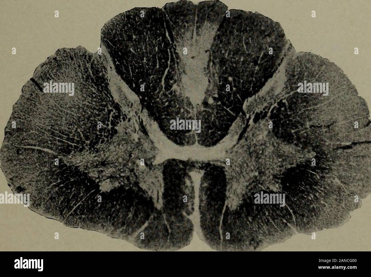 Sclerosed hi-res stock photography and images - Alamy