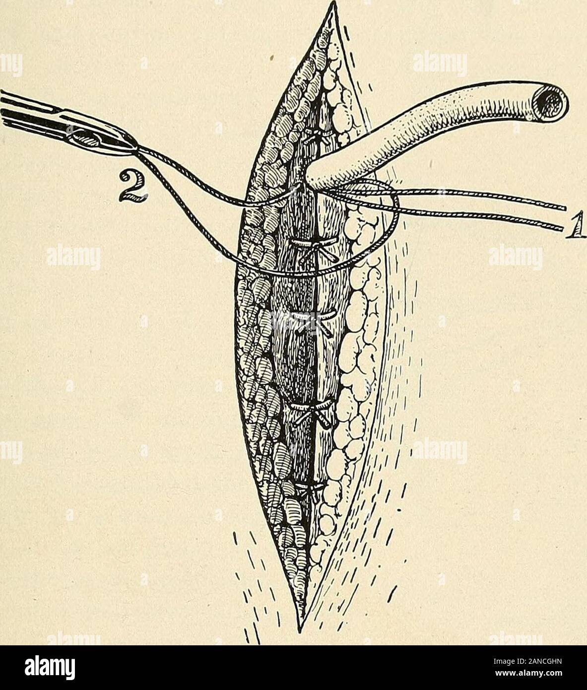 Purse string sutures hi-res stock photography and images - Alamy