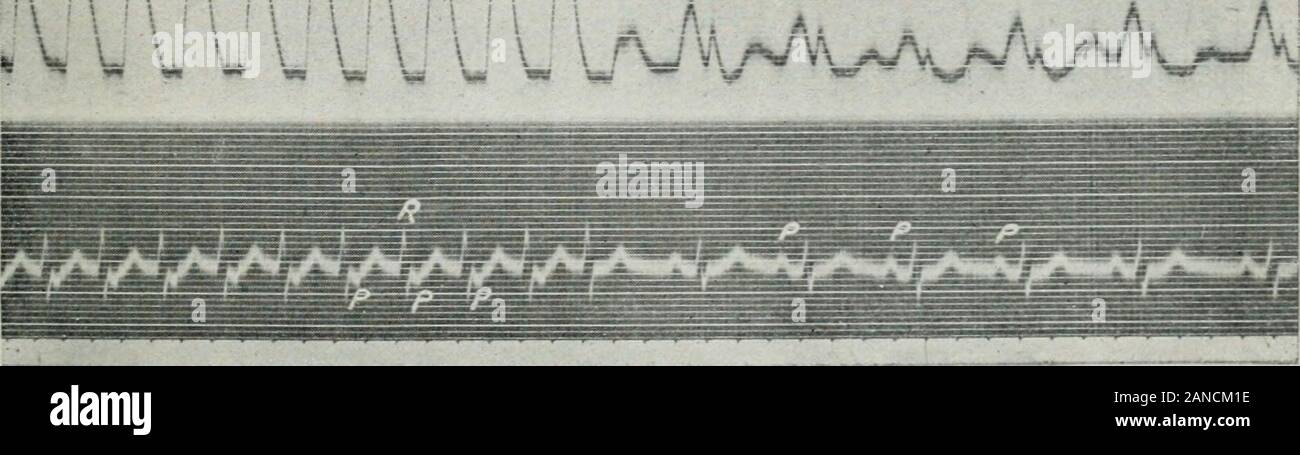 The Journal of laboratory and clinical medicine . ty of Michigan. Regular Ectopic Rhythms A77 ...