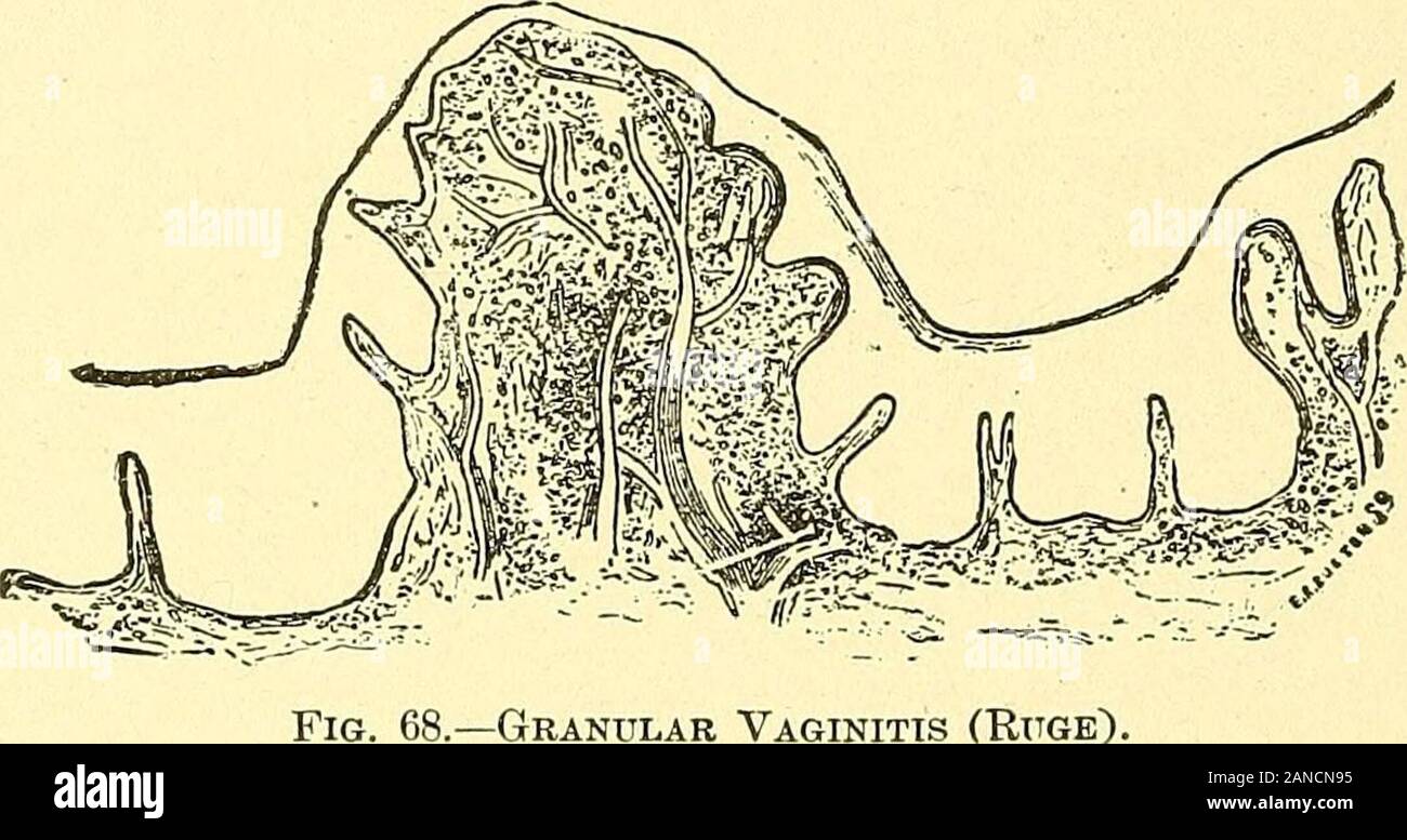 Treatise on gynaecology : medical and surgical . etations, discharges ...