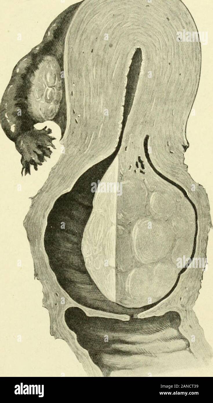 Myomas hi-res stock photography and images - Alamy