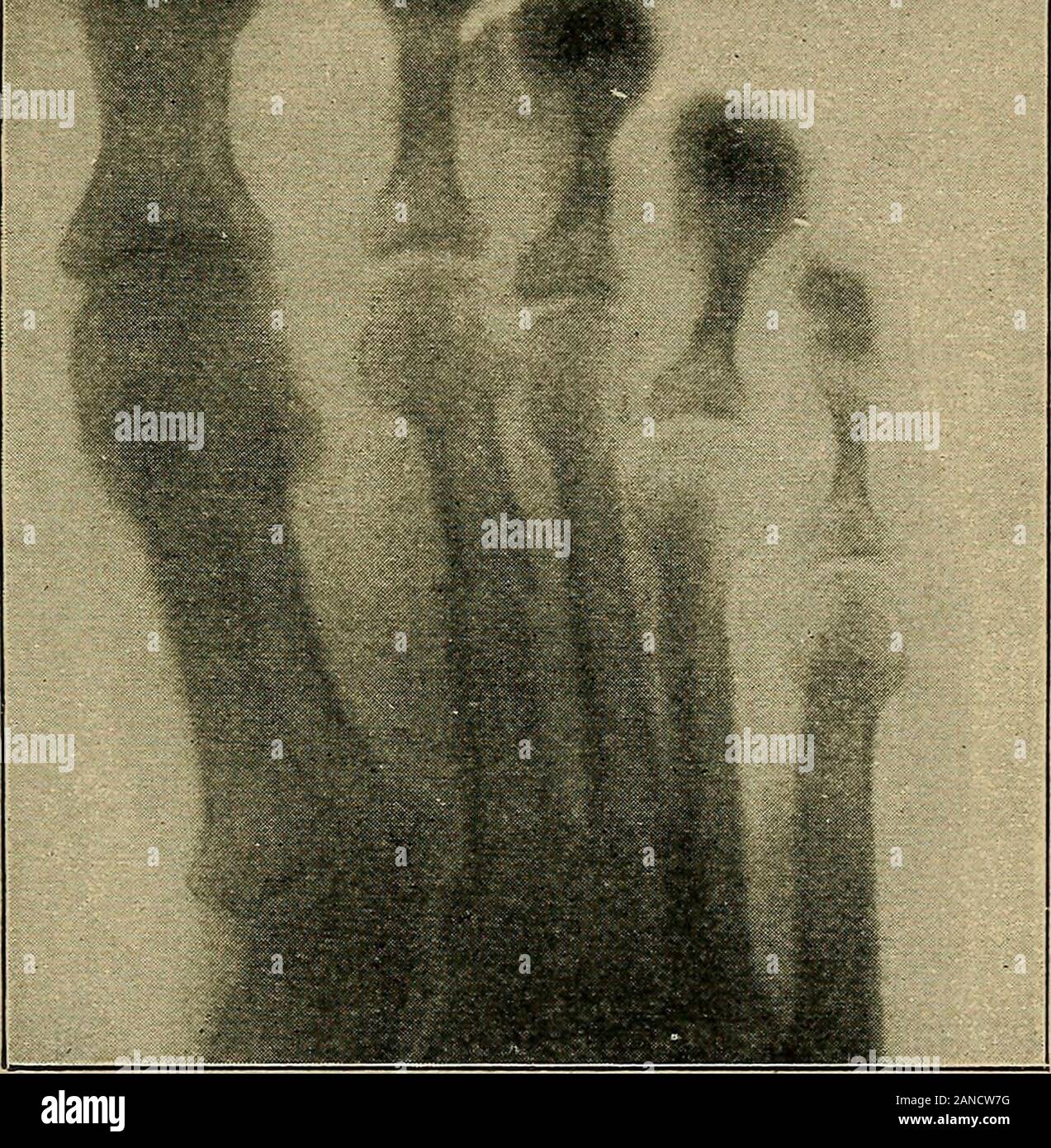 Atlas and epitome of traumatic fractures and dislocations . Fig. 155 ...