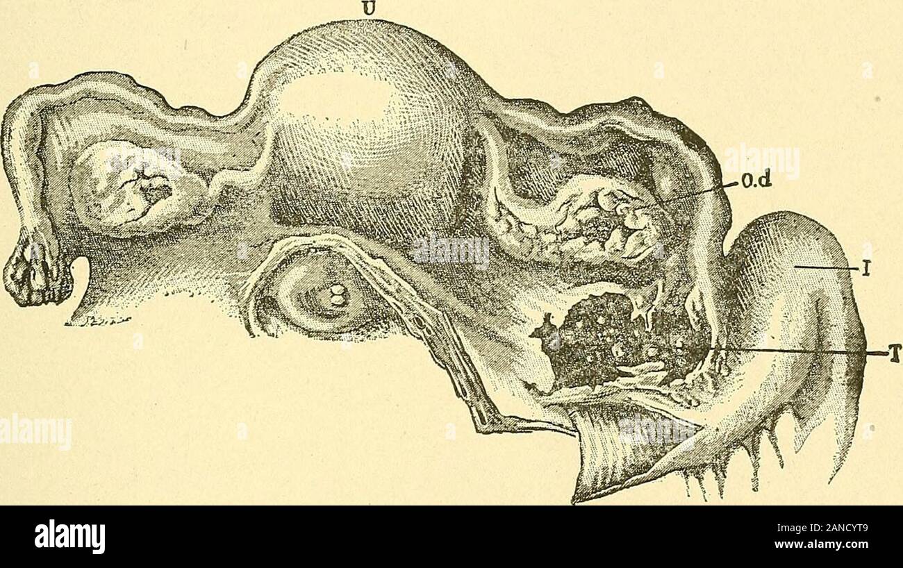 Laparatomy High Resolution Stock Photography and Images - Alamy