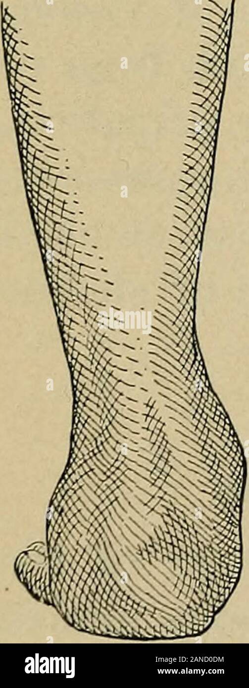 Atlas and epitome of traumatic fractures and dislocations . Fig. 152 ...